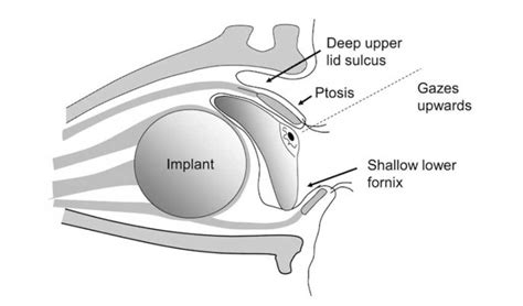 Socket Surgery For Prosthetic Eyes Nz Eye Reconstruction