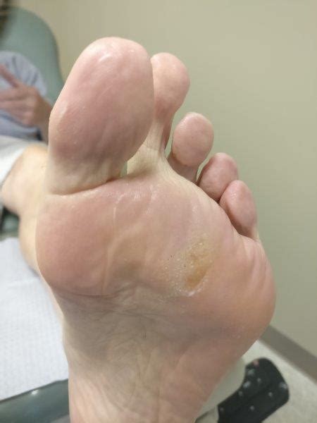 Insoles For Fat Pad Atrophy Clearance