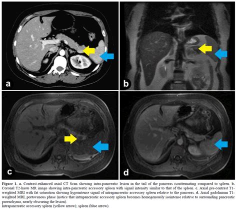 Intrapancreatic Accessory Spleen Investigative Dilemmas And Role