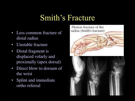 Ppt Management Of Extremity Fractures Powerpoint Presentation Free