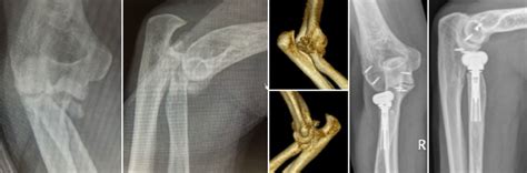8 Mason Iv Radial Head Fracture Treated With Radial Head Arthroplasty