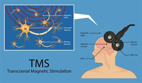 What Is Tms Tms Therapy Restore Brain