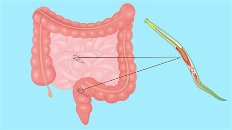 Pinworm Infection Causes Symptoms Diagnosis And Treatments Page 10