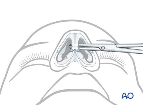 External Rhinoplasty Approach Open
