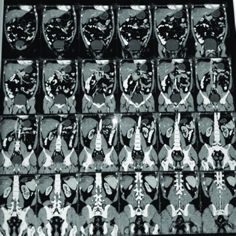 Cect Abdomen Showing Well Defined Enhancing Mass At The Base Of Bladder