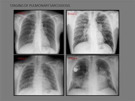 Sarcoidosis Lung Stages