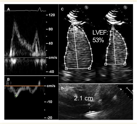 Figure 1 From Clinical Experience With Dual Pathway Inhibition Therapy