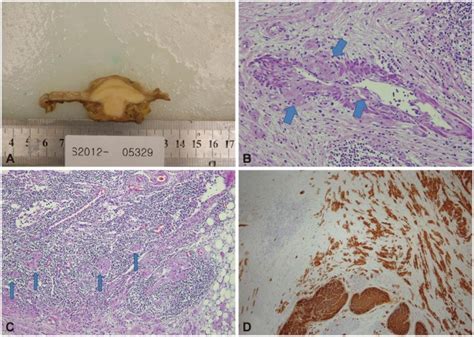 Pathologic Findings A Gross Findings After Segmental Colon Resection Download Scientific