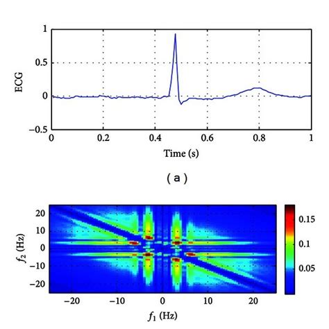 Electrocardiogram RSR Morphology In V1 Download Scientific Diagram