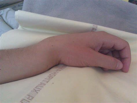 Explaining What Smith S Fracture Is Physioroom Blog