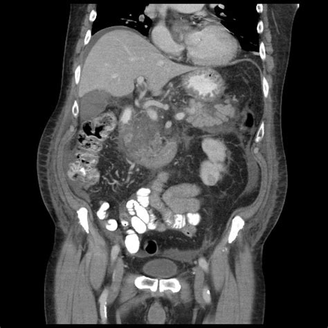 Filejourney Through Necrotizing Pancreatitis Presentation Walled