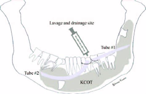 Marsupialization And Decompression Of The Cyst By Placing 2 No 5