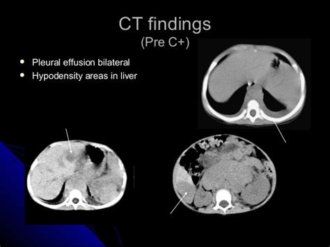 Neuroblastoma Ct Findings