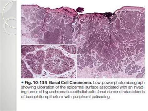 Basal Cell Carcinoma Of Oral Cavity Pptx