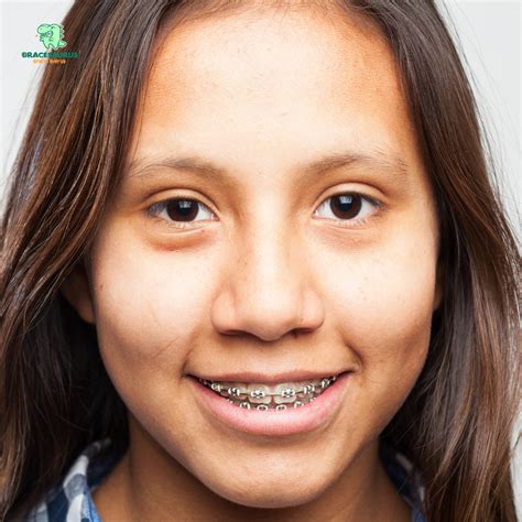 Teeth Braces In Singapore Which Option Is Right For Your Smile