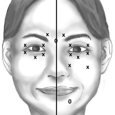 Jankovic Rating Scale Jankovic And Orman 1987 Download Scientific Diagram