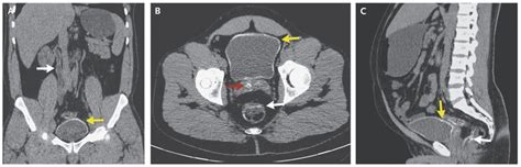 Eggshell Calcifications Of The Bladder Computed Tomography Grepmed