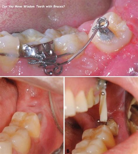 Can You Move Wisdom Teeth With Braces