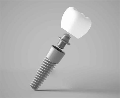 Common Dental Implant Problems And How To Overcome Them