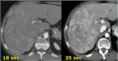The Radiology Assistant Ct Contrast Injection And Protocols