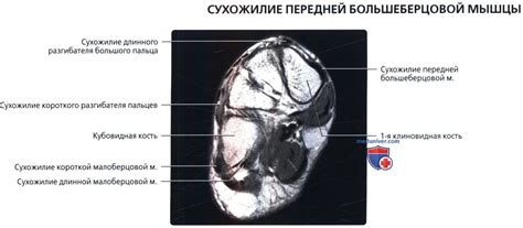 МРТ сухожилия передней большеберцовой мышцы в норме