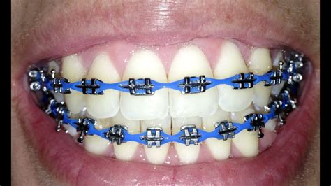 Power Chains Braces Real User Experiences And Advice