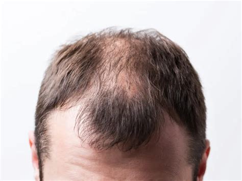 Diffuse Alopecia Solutions For Stronger Healthier Hair Growth Rootmd