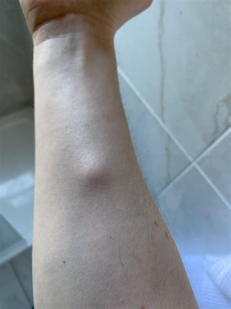 Hard Lump Under Skin Rmedicaladvice