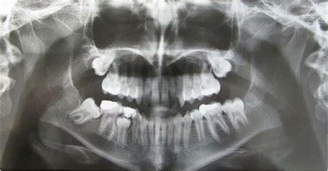 Fully Developed Mandibular Right Second Molar Mesially Angulated And