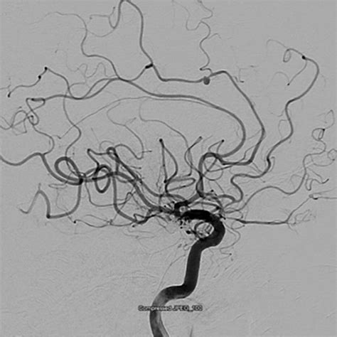 Repeat Angiogram On Post Bleed Day 9 Reveals A Pseudoaneurysm Of The Download Scientific
