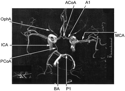 Mra Brain Anatomy Radiology Anatomy Images Arteries Anatomy Brain