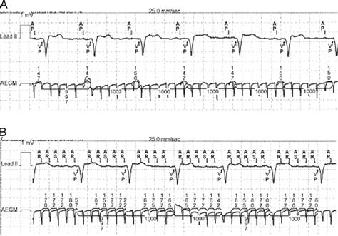 A Surface Lead Ii Atrial Intracardiac Electrogram Aegm And