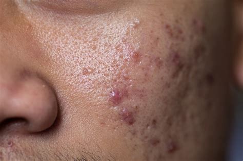 Acne In Men Causes And Coping