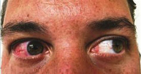 Heres What Zika Virus Infection Looks Like Nbc News
