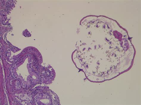 Enterobius Vermicularis In The Gallbladder Lumen With Cuticle And Two Download Scientific