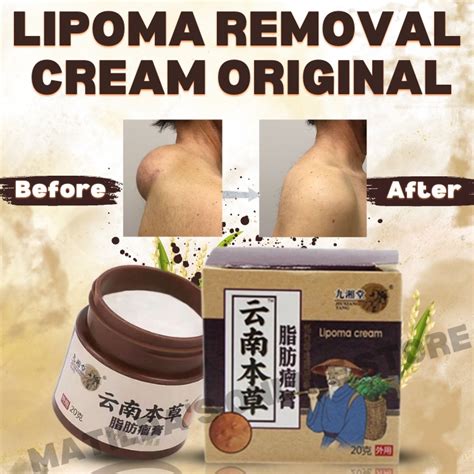Lipoma Original Japan Lipoma Pang Tanggal Ng Bukol Bukol Sa Katawan