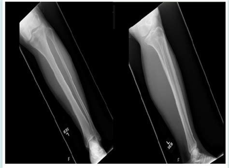 Using Musculoskeletal Ultrasound To Identify A Tibial Metadiaphysis