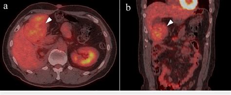 Positron Emission Tomography Image Of The Abdominal Mass Axial A And