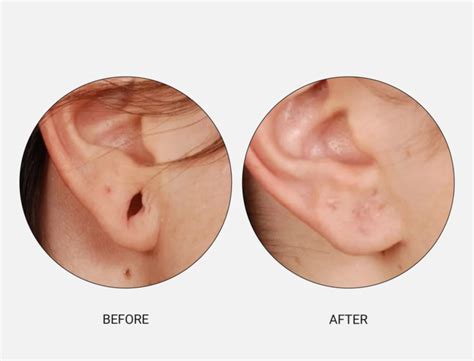 Ear Lobe Repair Drsharvaripandit
