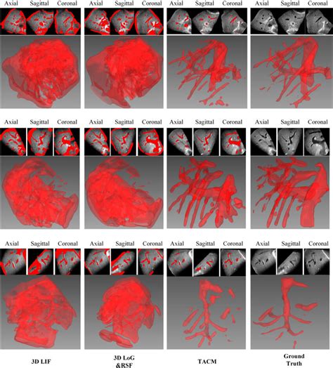Comparison Between The Liver Vessel Segmentation Results Between The 3d Download Scientific