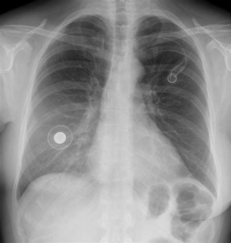 Breast Tissue Expander Buyxraysonline