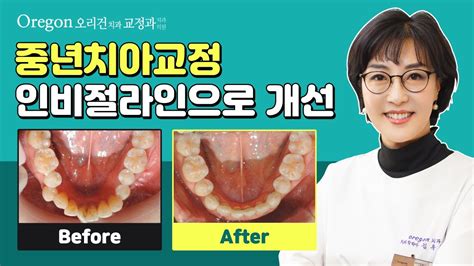 중년치아교정│인비절라인 투명교정으로 개선한 사례 【오리건치과】에서 확인하세요 Youtube