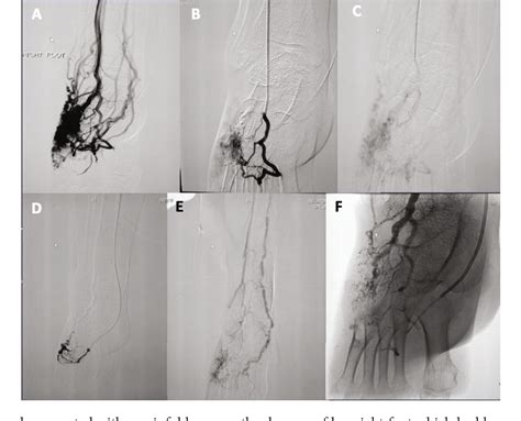 Figure 1 From Peripheral Arteriovenous Malformation Embolization Using Squid Semantic Scholar