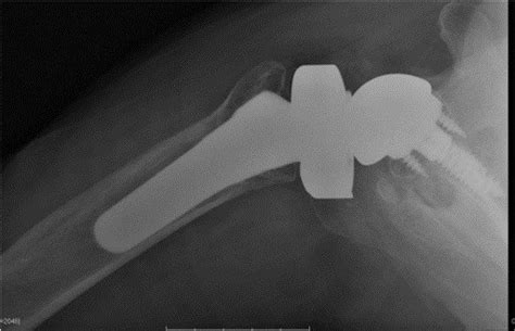 Biomet Comprehensive Mini American Shoulder And Elbow Surgeons