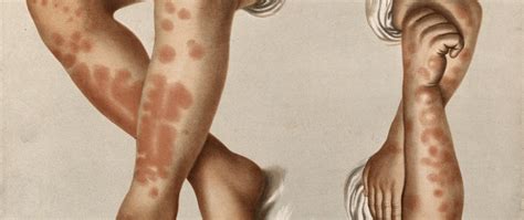 Erythema Nodosum Immunközpont