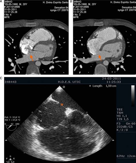 Ostium Secundum Type Atrial Septal Defect A And B Cardiac CT C