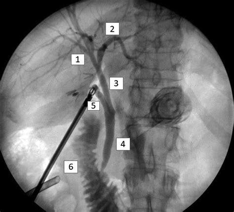 Should We Utilize Routine Cholangiography Advances In Surgery