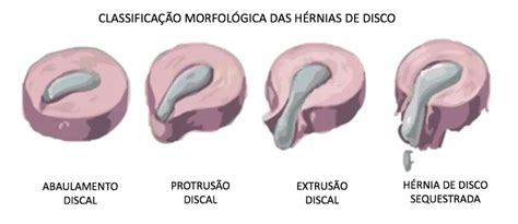 Protusão Discal tem cura Dr William Zarza