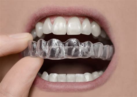 Pourquoi utiliser une plaque occlusale pour protéger vos dents