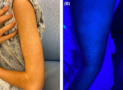 Progressive Macular Hypomelanosis Treatment